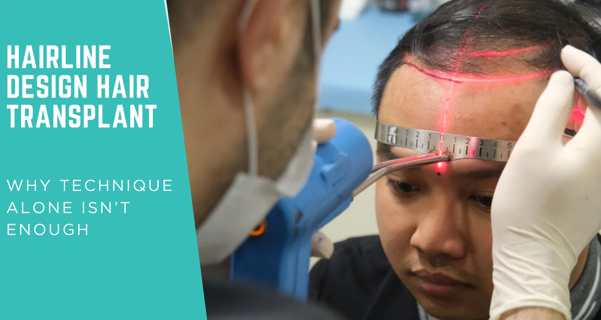 Hairline Design Hair Transplant: Natural Hairline Guide